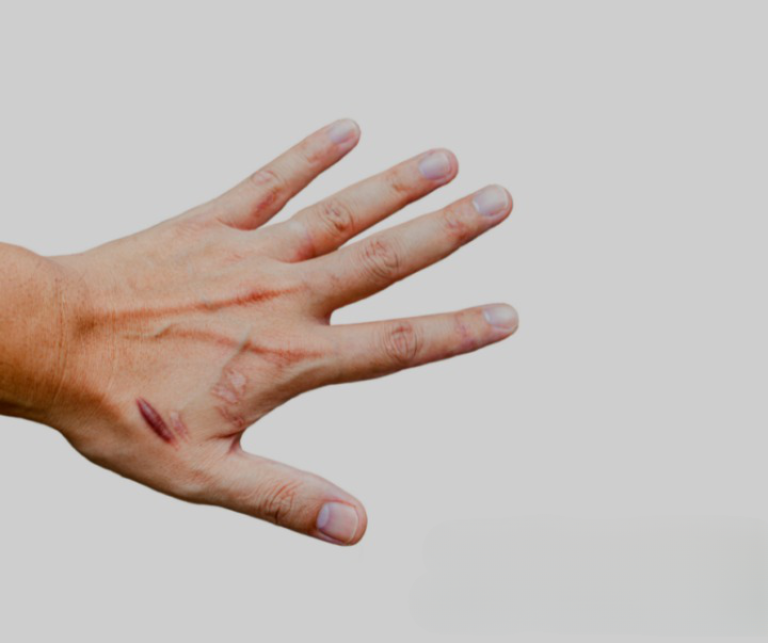 New Jersey Dog Bite Lawyers | Dog Bite Attorney Near Me | Console ...